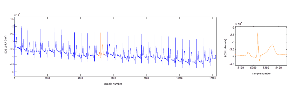 Sample Data - Shimmer Wearable Sensor Technology