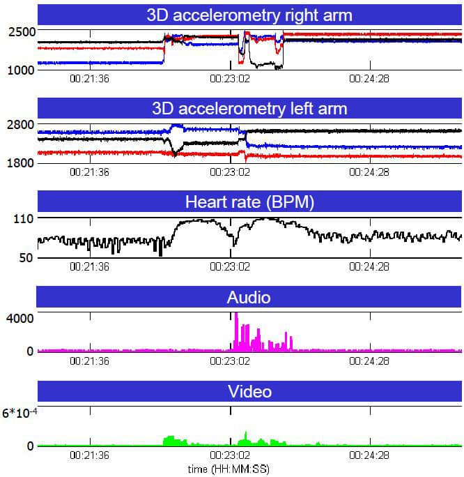 Tele-Epilepsy and Remote Seizure Monitoring using Shimmer Sensors
