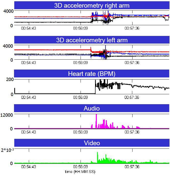 Tele-Epilepsy and Remote Seizure Monitoring using Shimmer Sensors